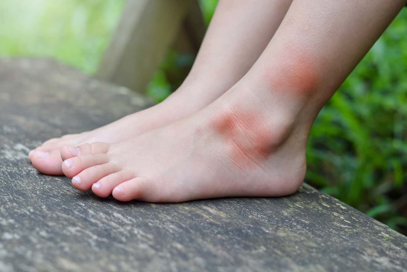 Skeeter Syndrome: Mosquito Bites That Last and Last | The People's Pharmacy