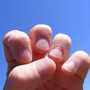 Coping with Cracked Fingertips | The People's Pharmacy