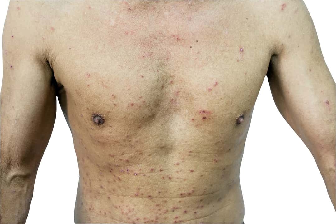 Drugs That Can Cause Life-Threatening Skin Rashes | The People's Pharmacy