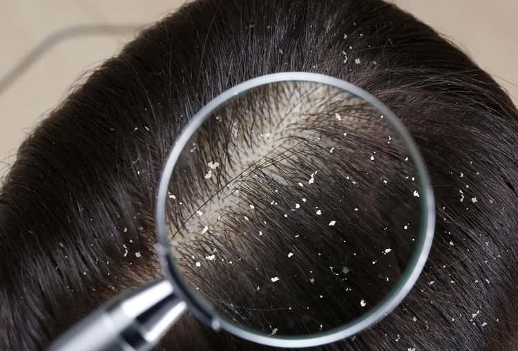 Dandruff: Why Yeast Feast and How to Control the Flakes | The People's ...