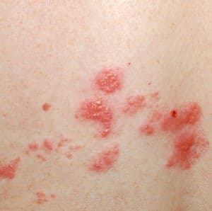 Using L-Lysine Against Shingles | The People's Pharmacy